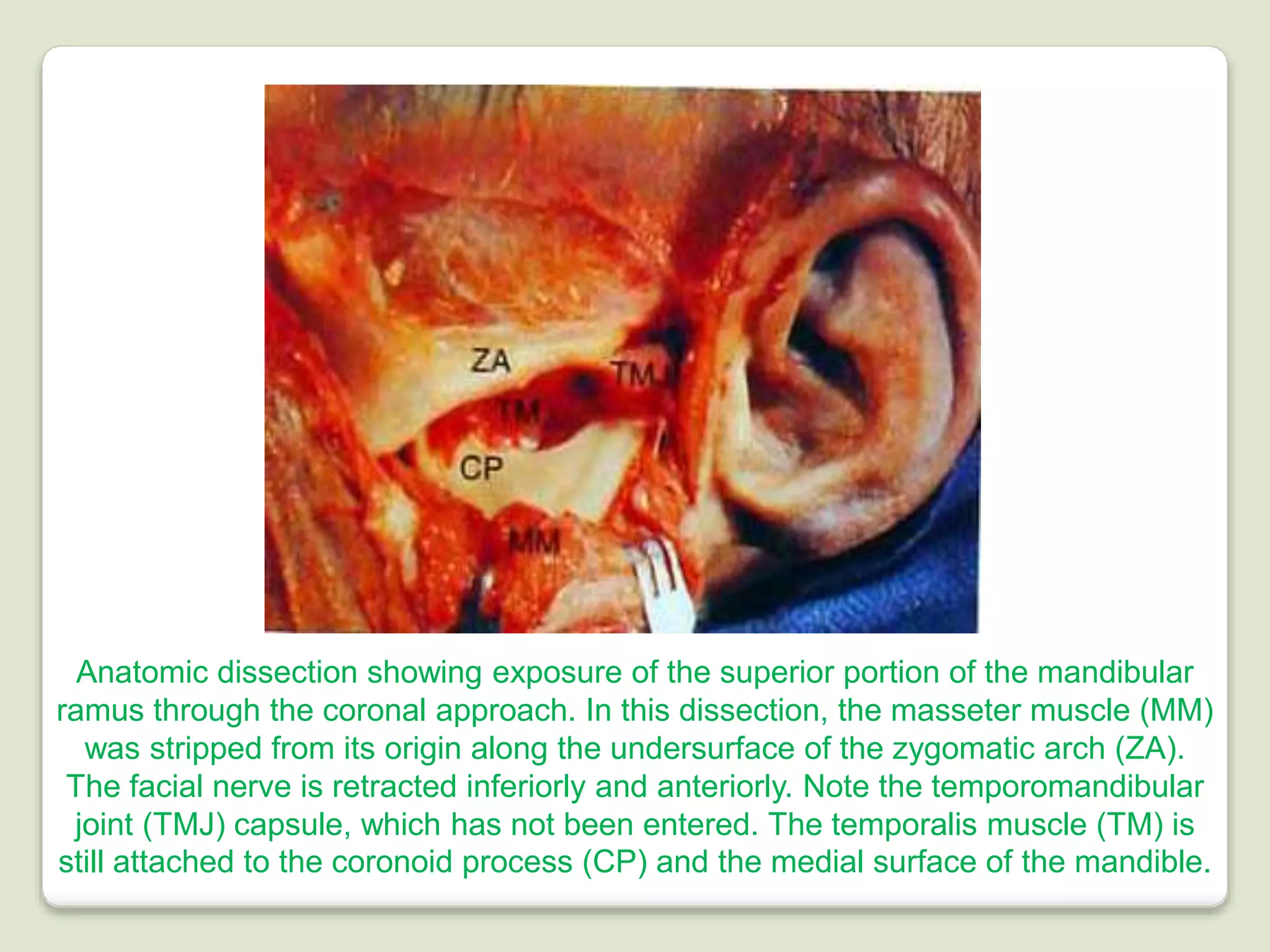 Surgical approaches to the facial skeleton | PPTX