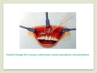 Surgical approaches to the facial skeleton | PPTX