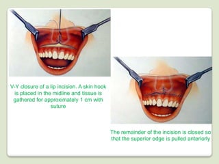 Surgical approaches to the facial skeleton | PPTX