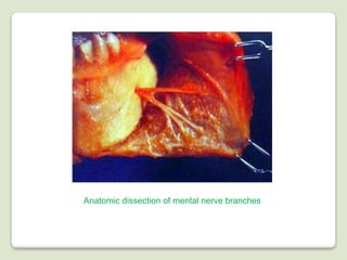 Surgical approaches to the facial skeleton | PPTX