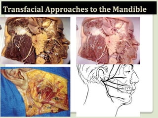 Surgical approaches to the facial skeleton | PPTX