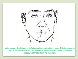 Surgical approaches to the facial skeleton | PPTX
