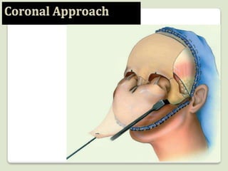 Coronal Approach