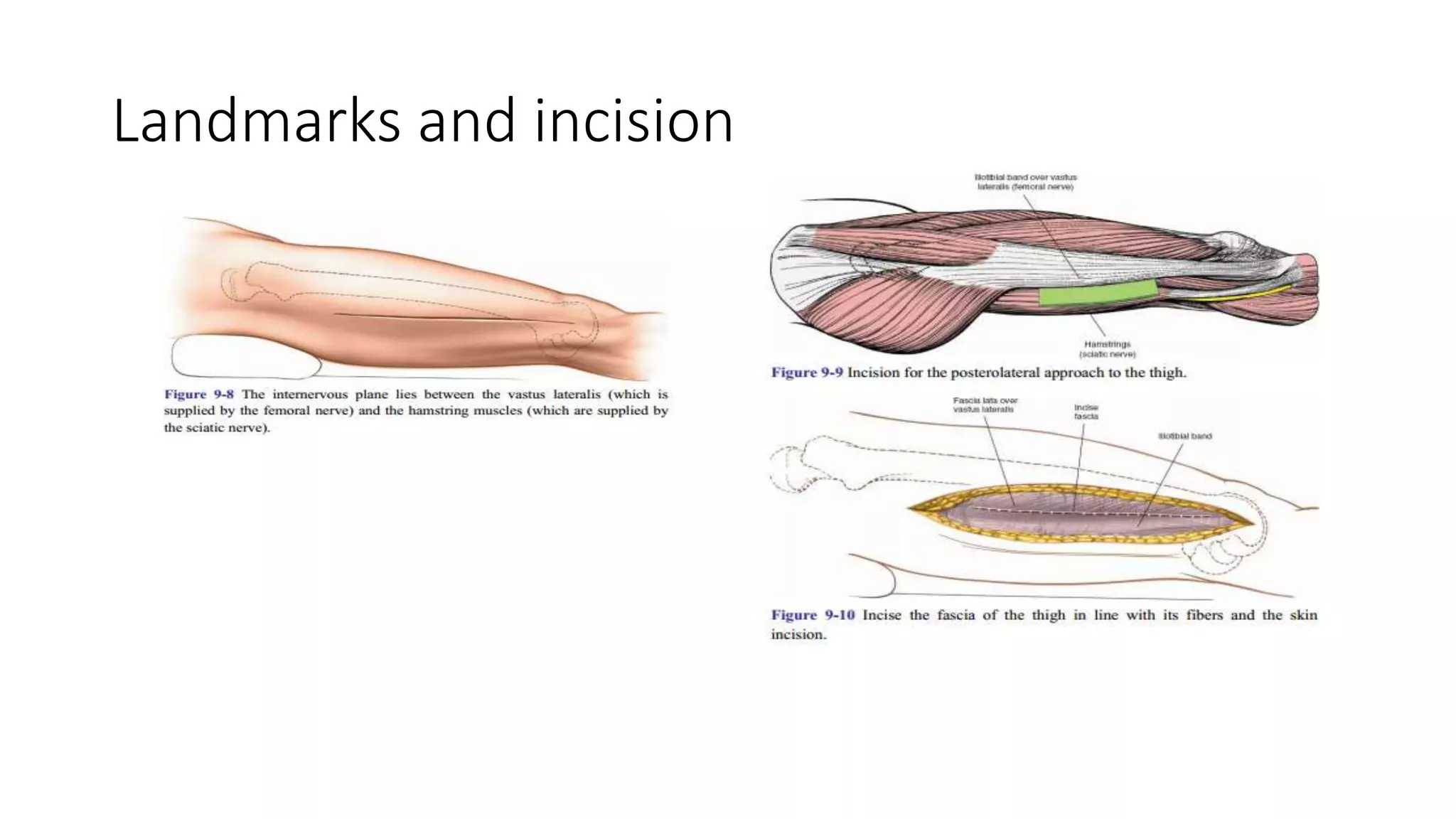 Surgical Approaches to the Femur.pptx