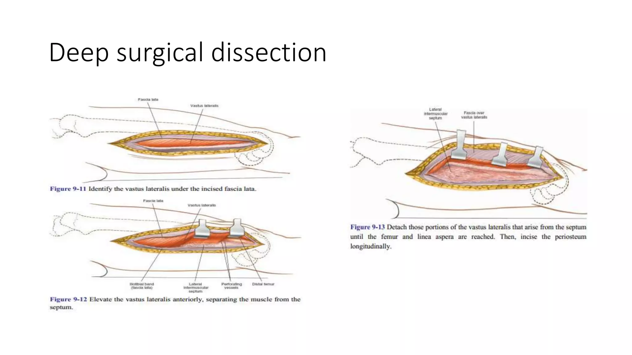 Surgical Approaches to the Femur.pptx