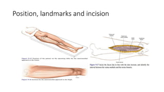 Surgical Approaches to the Femur.pptx