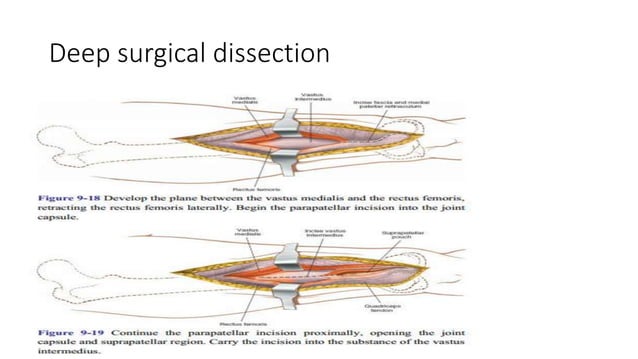 Surgical Approaches to the Femur.pptx