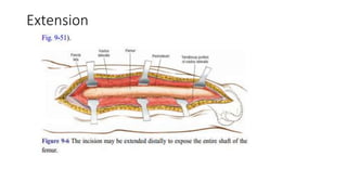 Surgical Approaches to the Femur.pptx