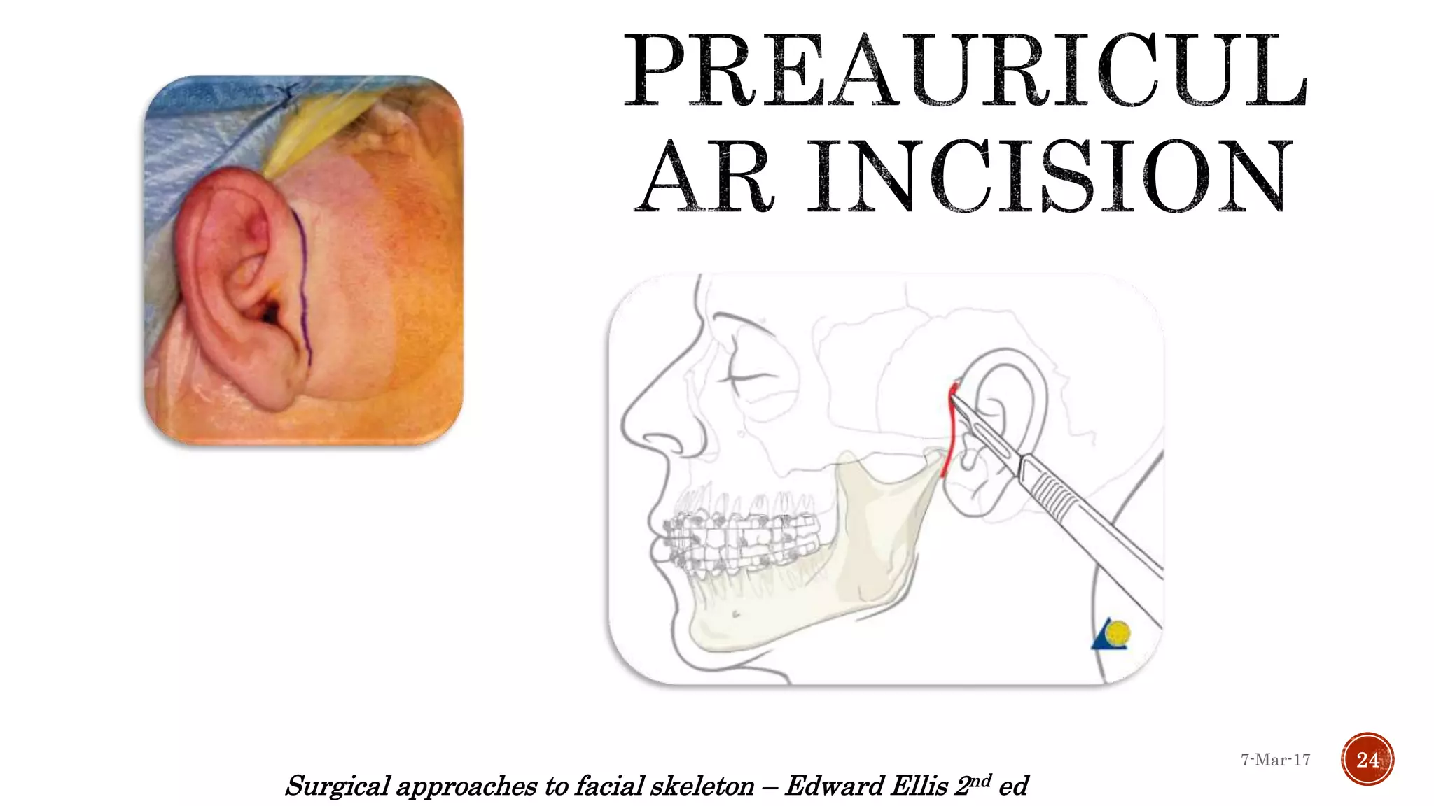 Surgical approaches to tmj | PPTX | Ear, Nose and Throat Conditions ...