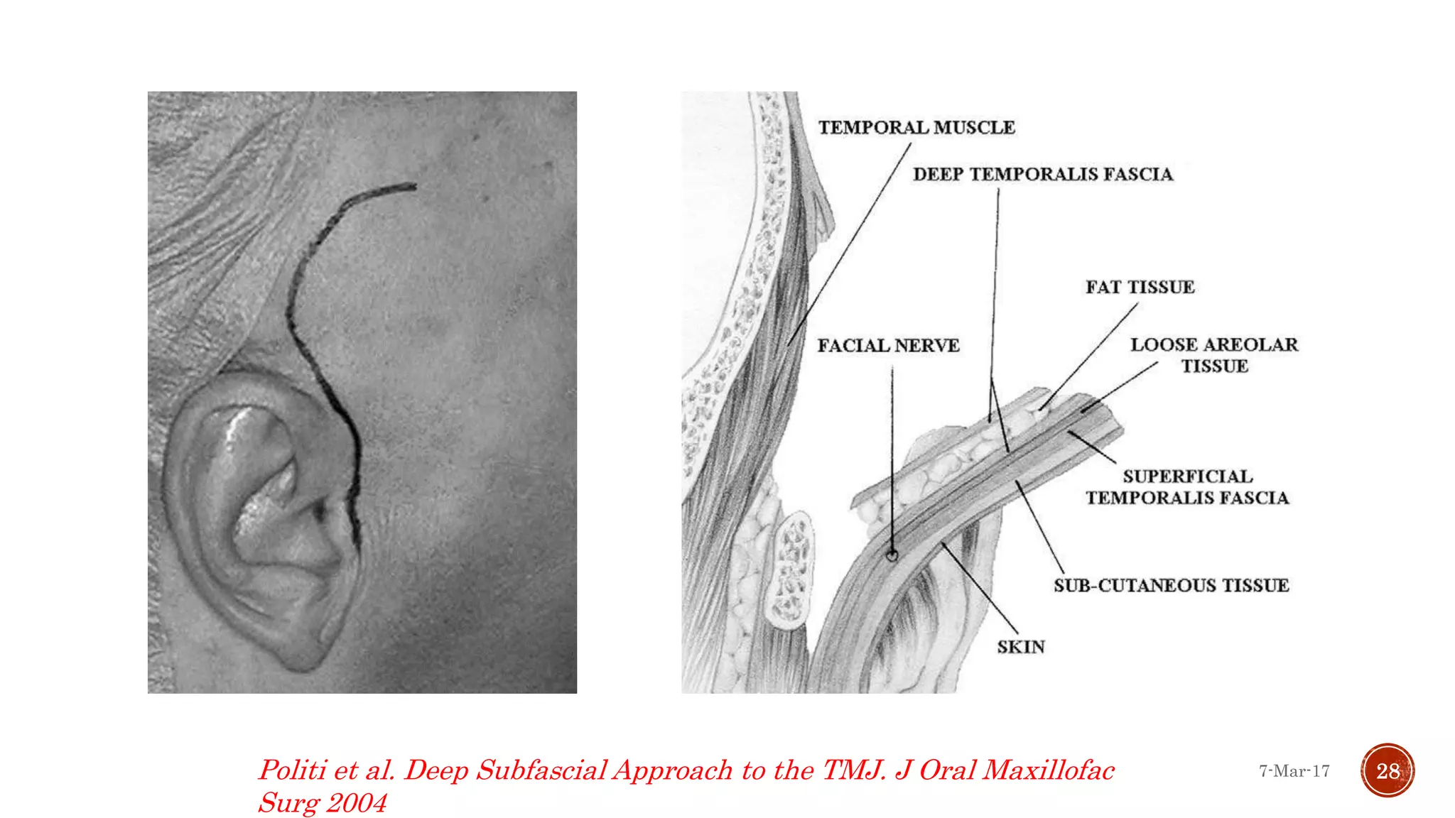 Surgical approaches to tmj | PPTX
