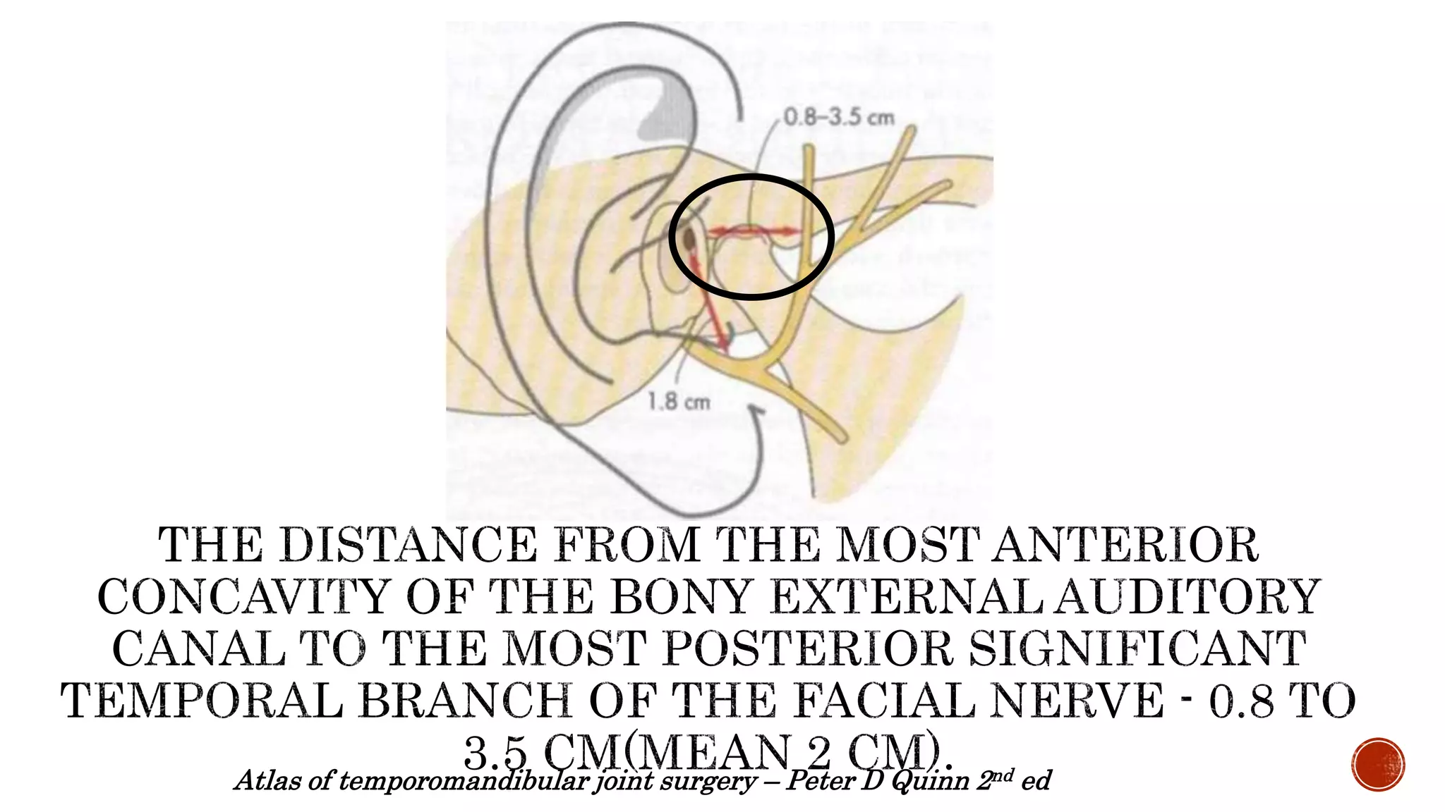 Surgical approaches to tmj | PPTX