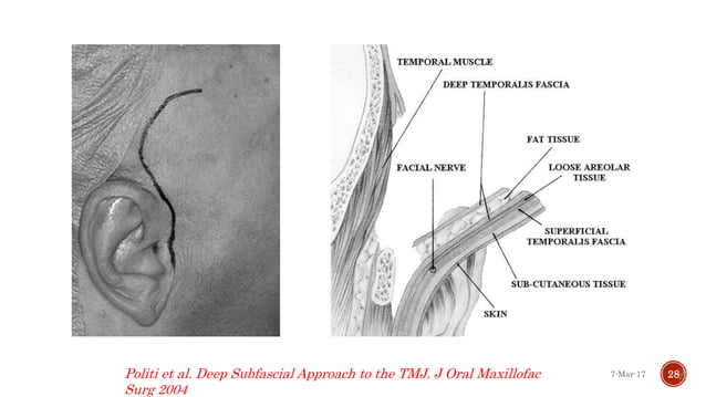 Surgical approaches to tmj | PPTX | Ear, Nose and Throat Conditions ...
