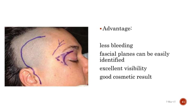 Surgical approaches to tmj | PPTX | Ear, Nose and Throat Conditions ...