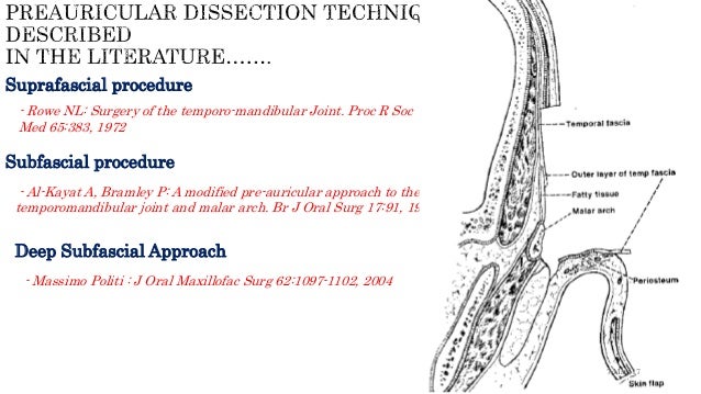 Surgical approaches to tmj