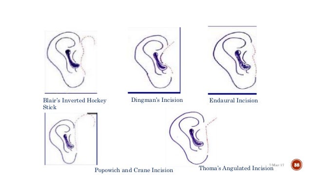 Surgical approaches to tmj