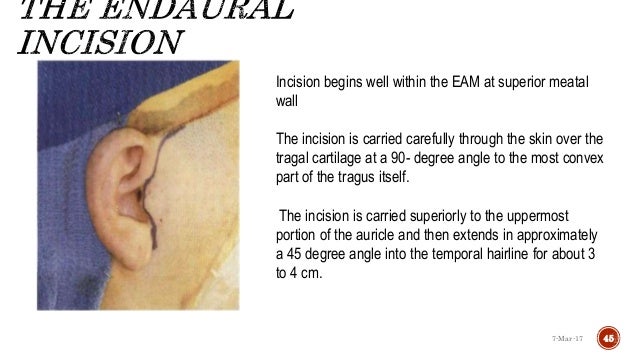 Surgical approaches to tmj