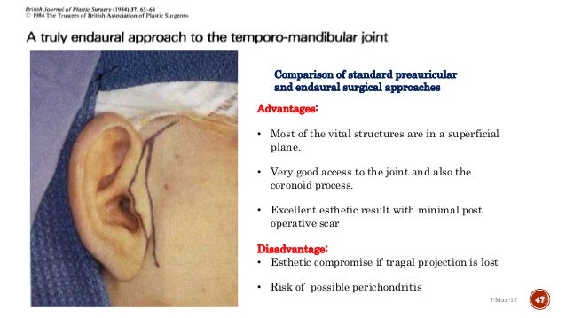 Surgical approaches to tmj