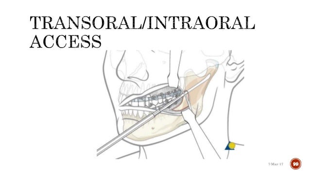 Surgical approaches to tmj