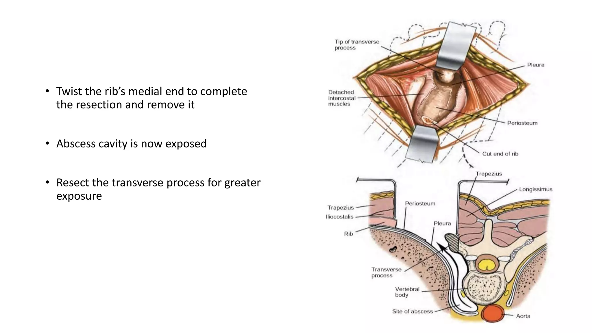 Surgical approach for thoracic and lumbosacral spine | PPTX