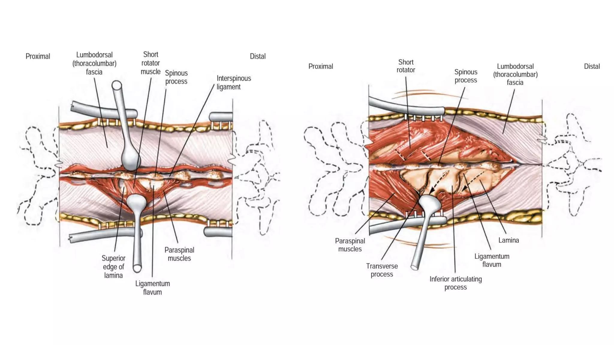Surgical approach for thoracic and lumbosacral spine | PPTX