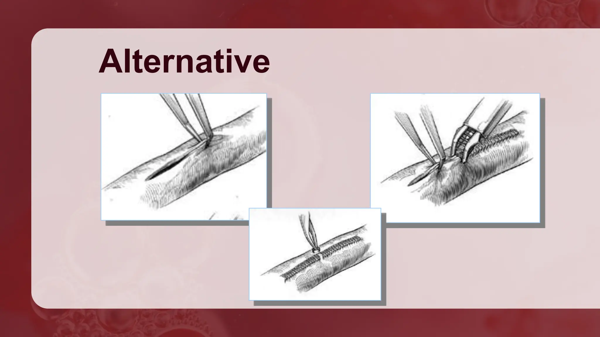 Surgical Approach for Vascular Extremiti | PPT