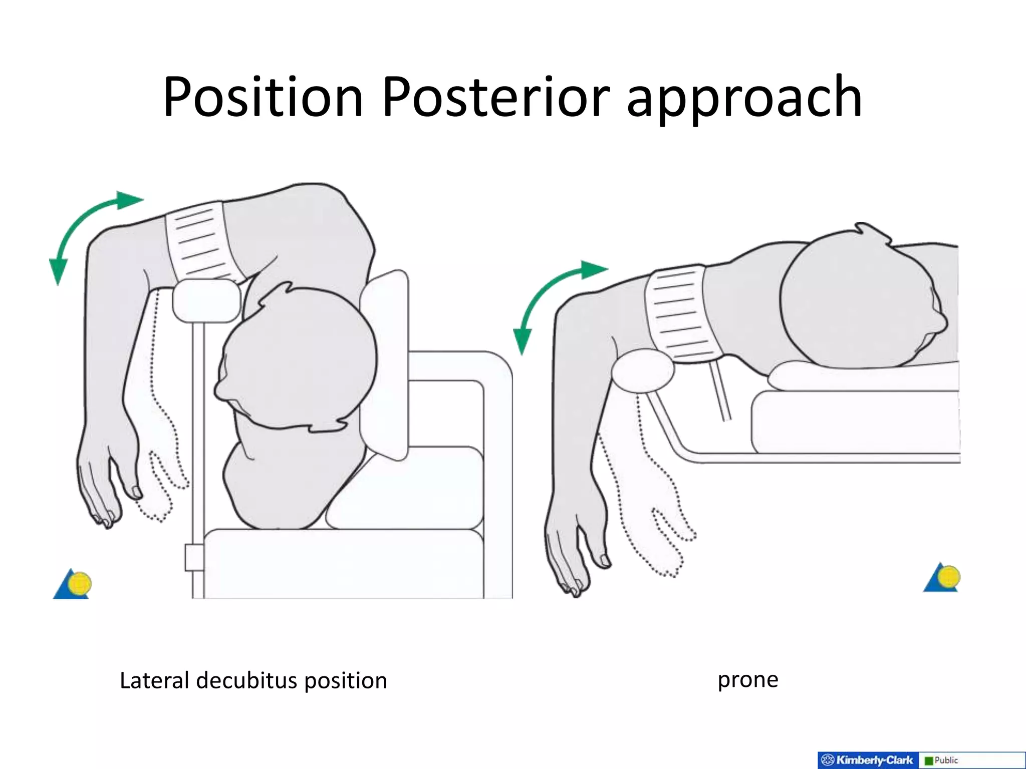Surgical approach intercondylar/ supracondylar humerus fracture | PPT