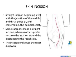 Surgical approach intercondylar/ supracondylar humerus fracture | PPT