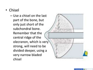 Surgical approach intercondylar/ supracondylar humerus fracture | PPT