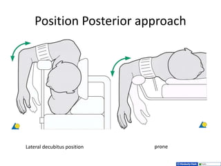 Surgical approach intercondylar/ supracondylar humerus fracture | PPT