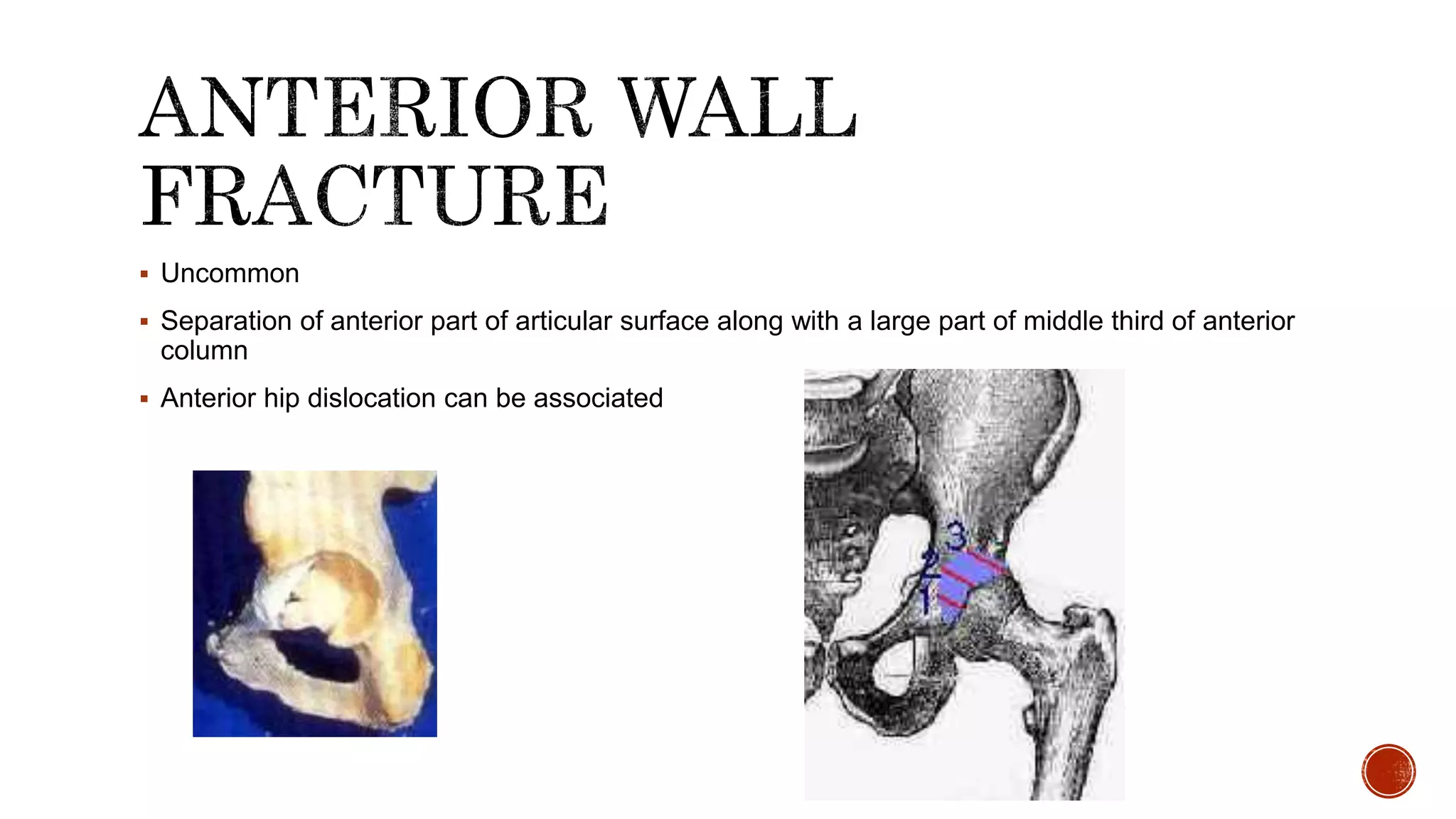 Surgical approach to acetabulum and pelvis | PPTX