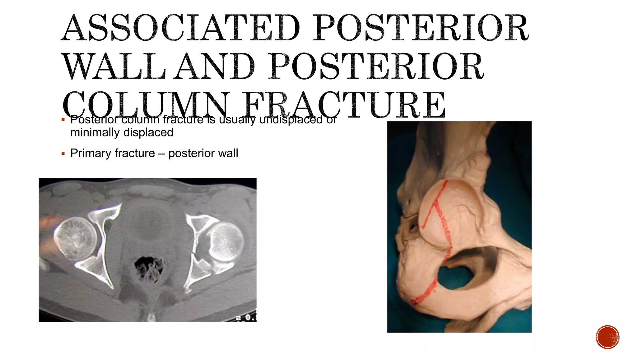 Surgical approach to acetabulum and pelvis | PPTX