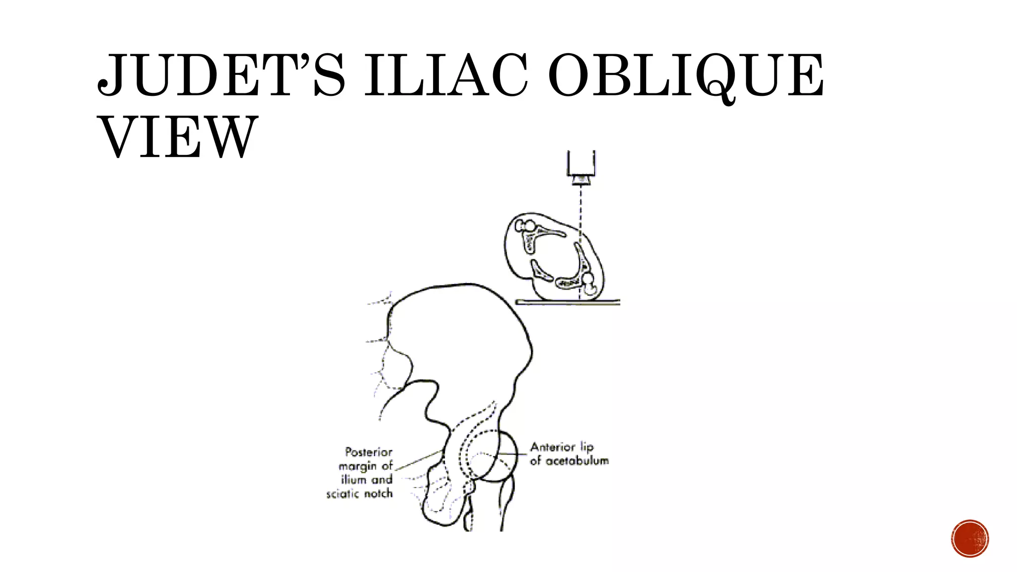 Surgical approach to acetabulum and pelvis | PPTX