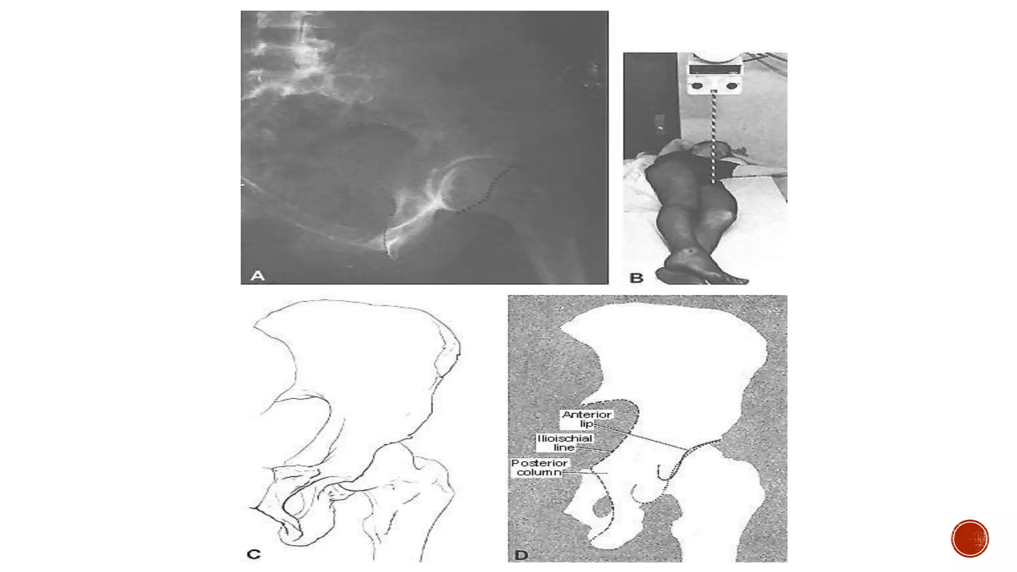 Surgical approach to acetabulum and pelvis | PPTX