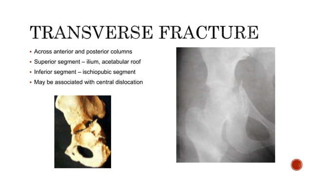 Surgical approach to acetabulum and pelvis | PPTX