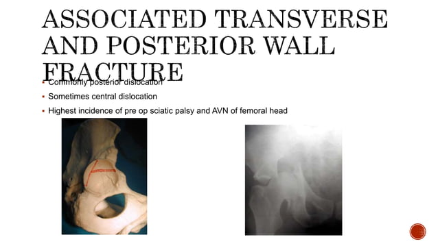 Surgical approach to acetabulum and pelvis | PPTX
