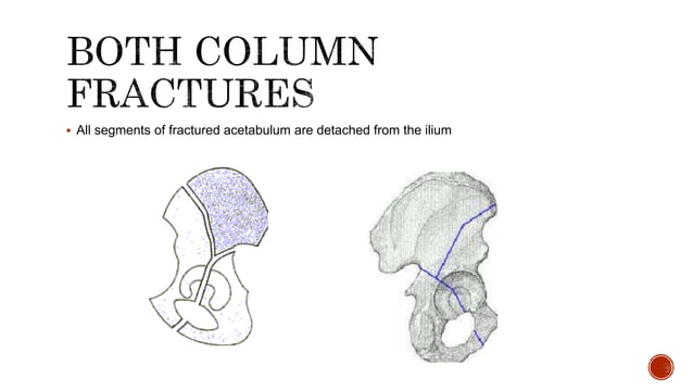 Surgical approach to acetabulum and pelvis | PPTX