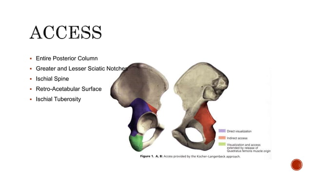 Surgical approach to acetabulum and pelvis | PPTX