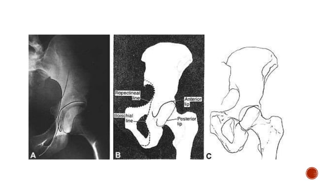 Surgical approach to acetabulum and pelvis | PPTX