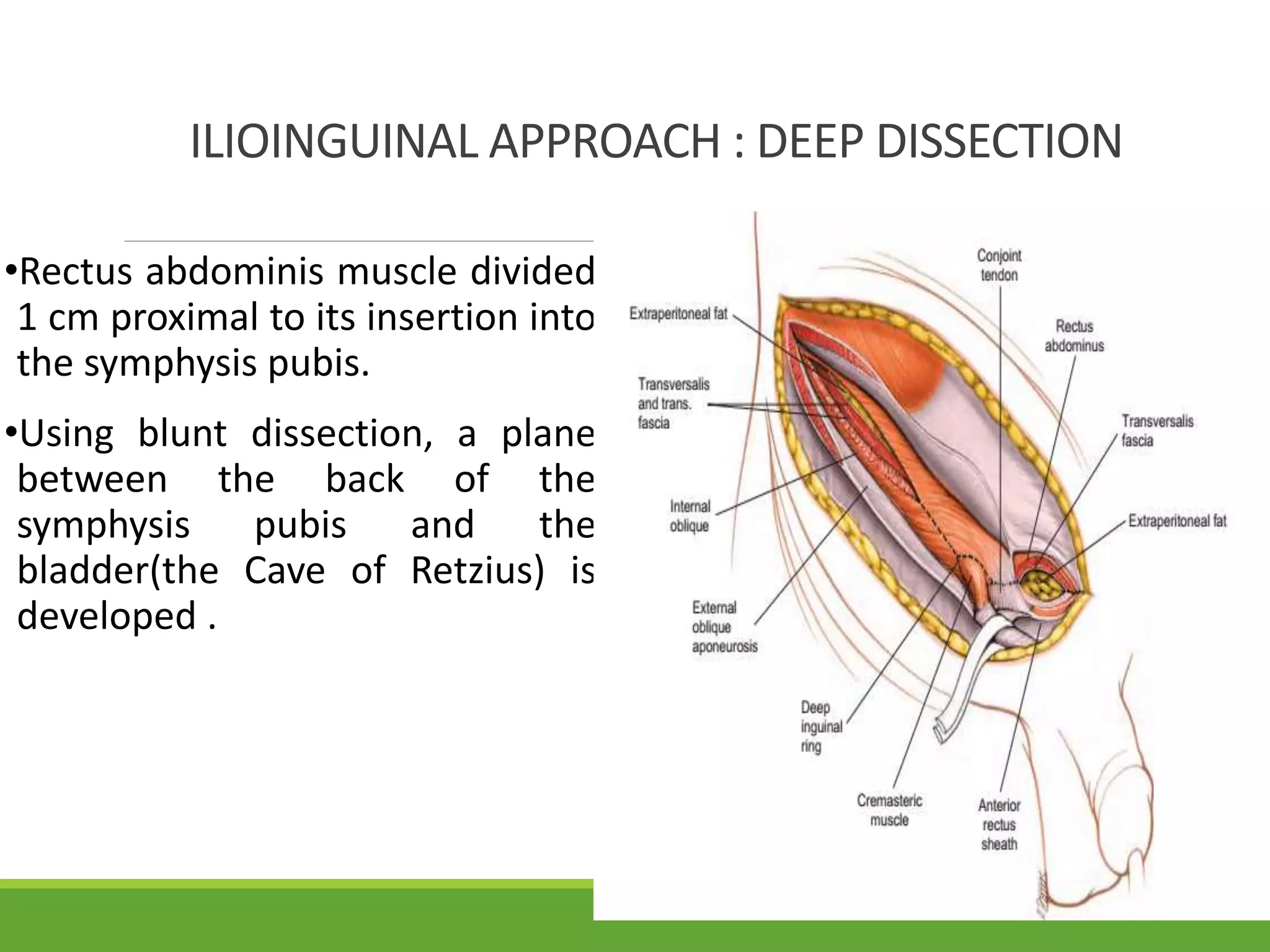 Surgical Approaches to Acetabulum and Pelvis | PPTX