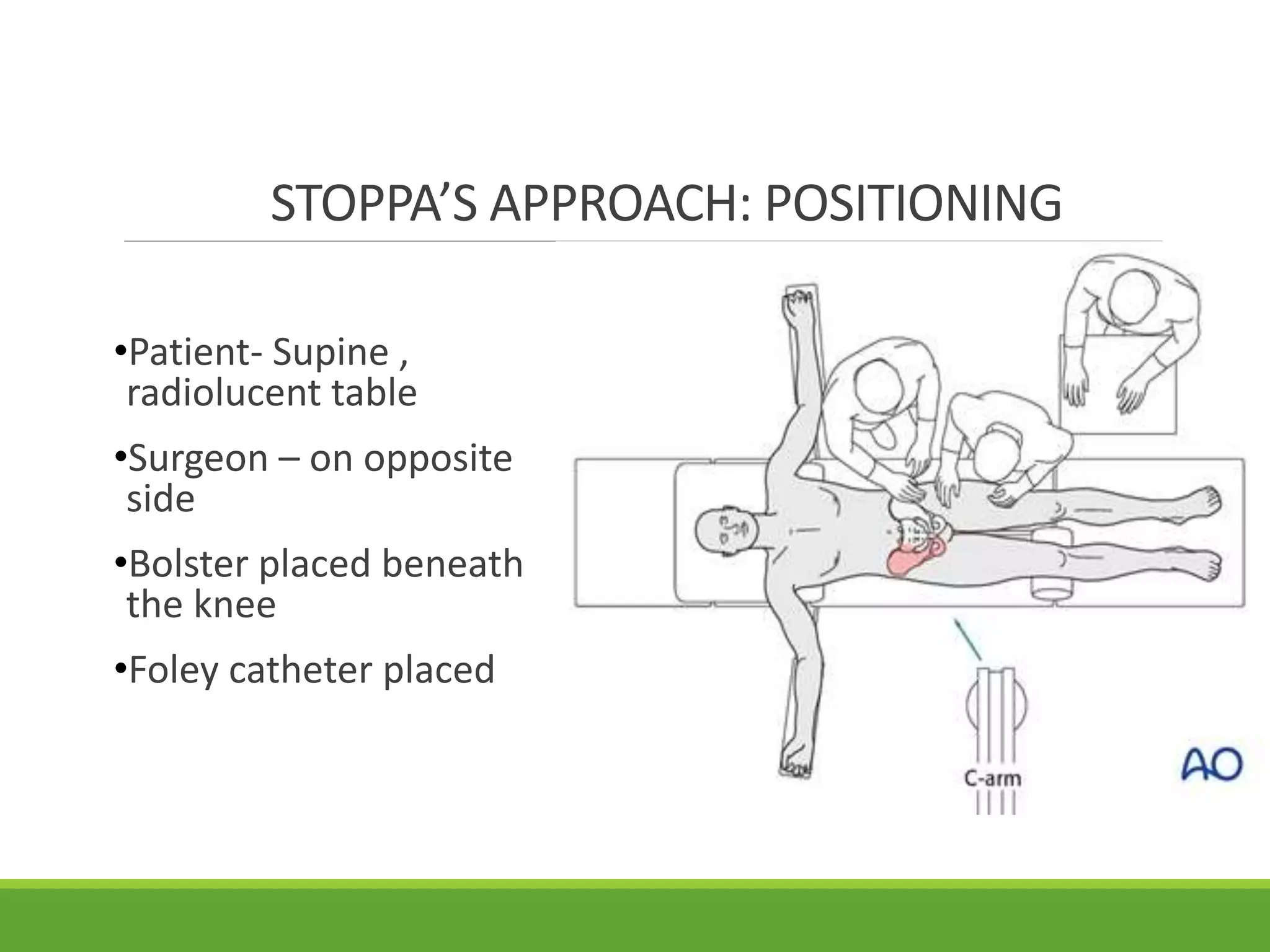 Surgical Approaches to Acetabulum and Pelvis | PPTX