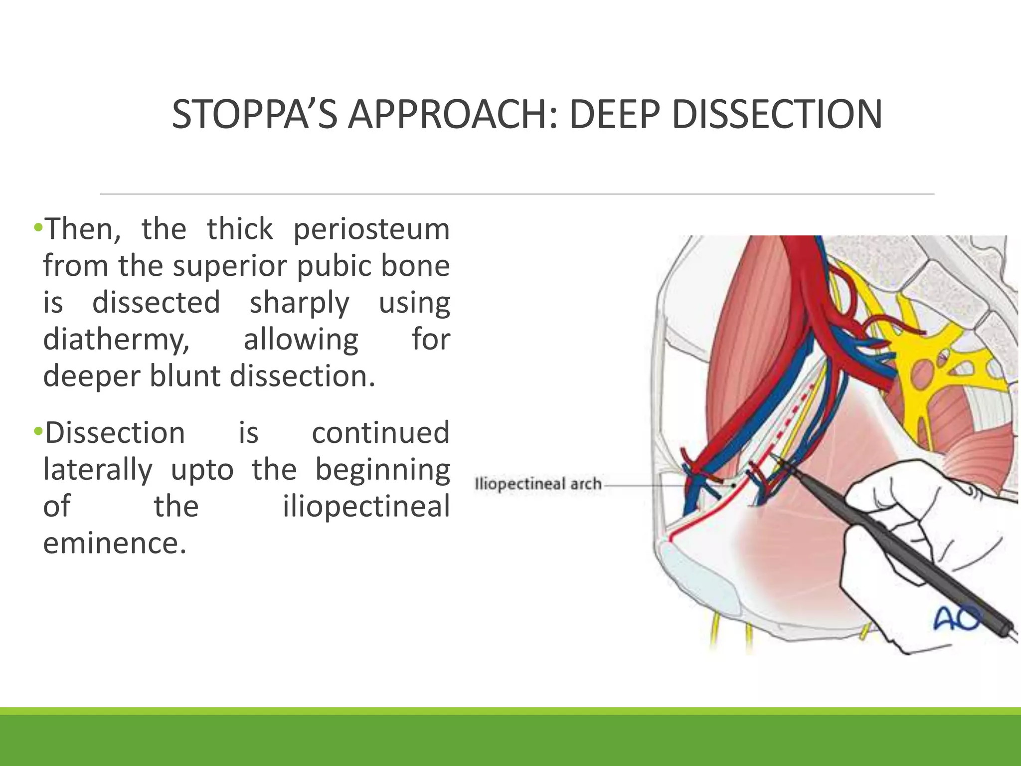 Surgical Approaches to Acetabulum and Pelvis | PPTX