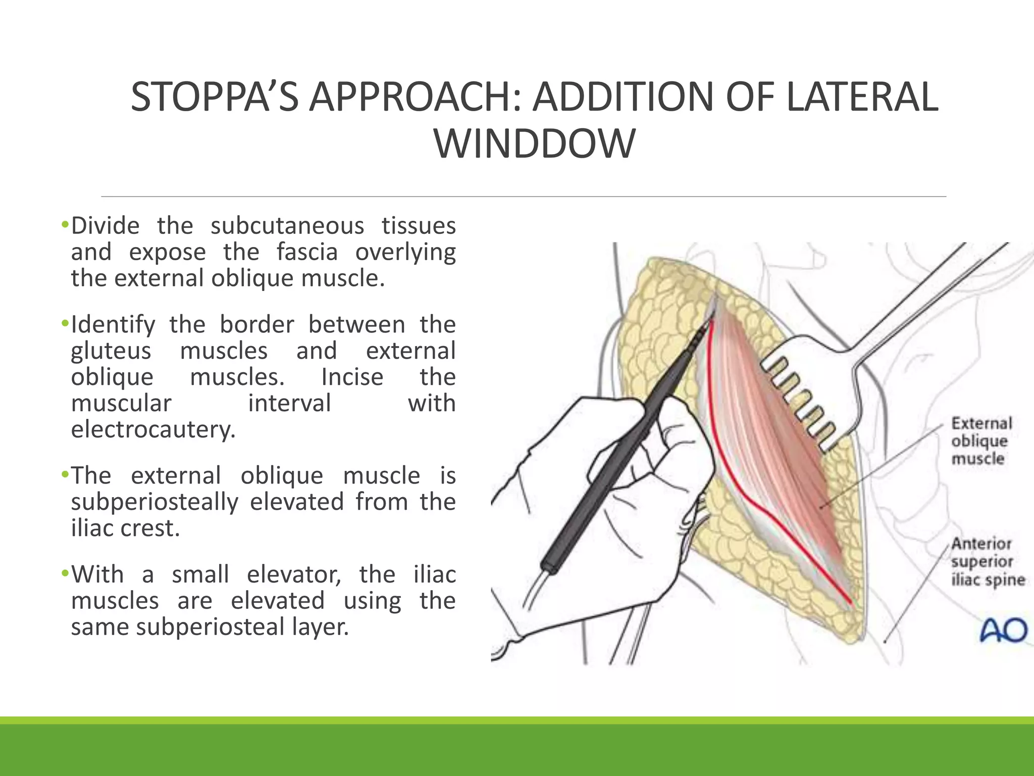 Surgical Approaches to Acetabulum and Pelvis | PPTX