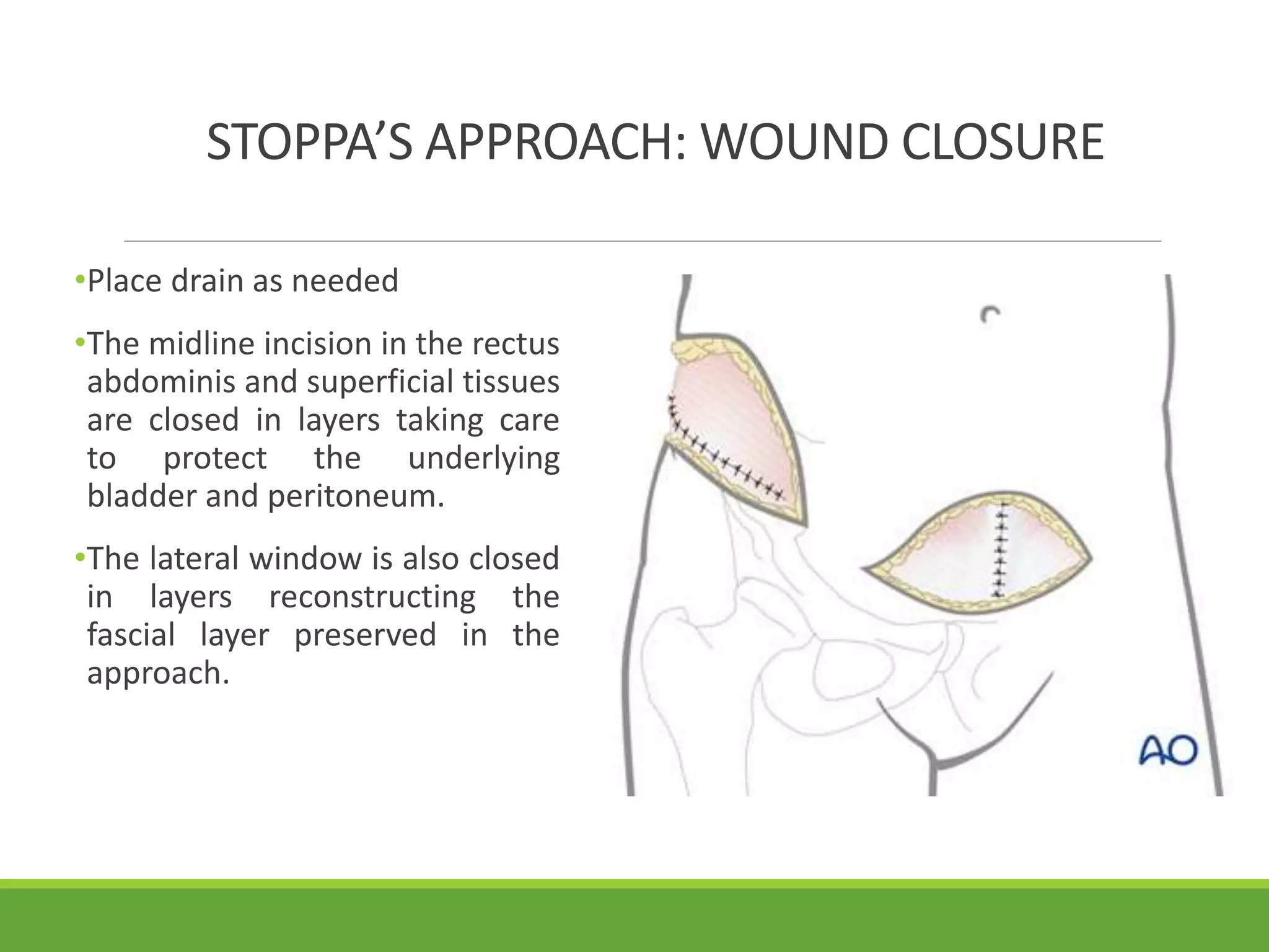 Surgical Approaches to Acetabulum and Pelvis | PPTX