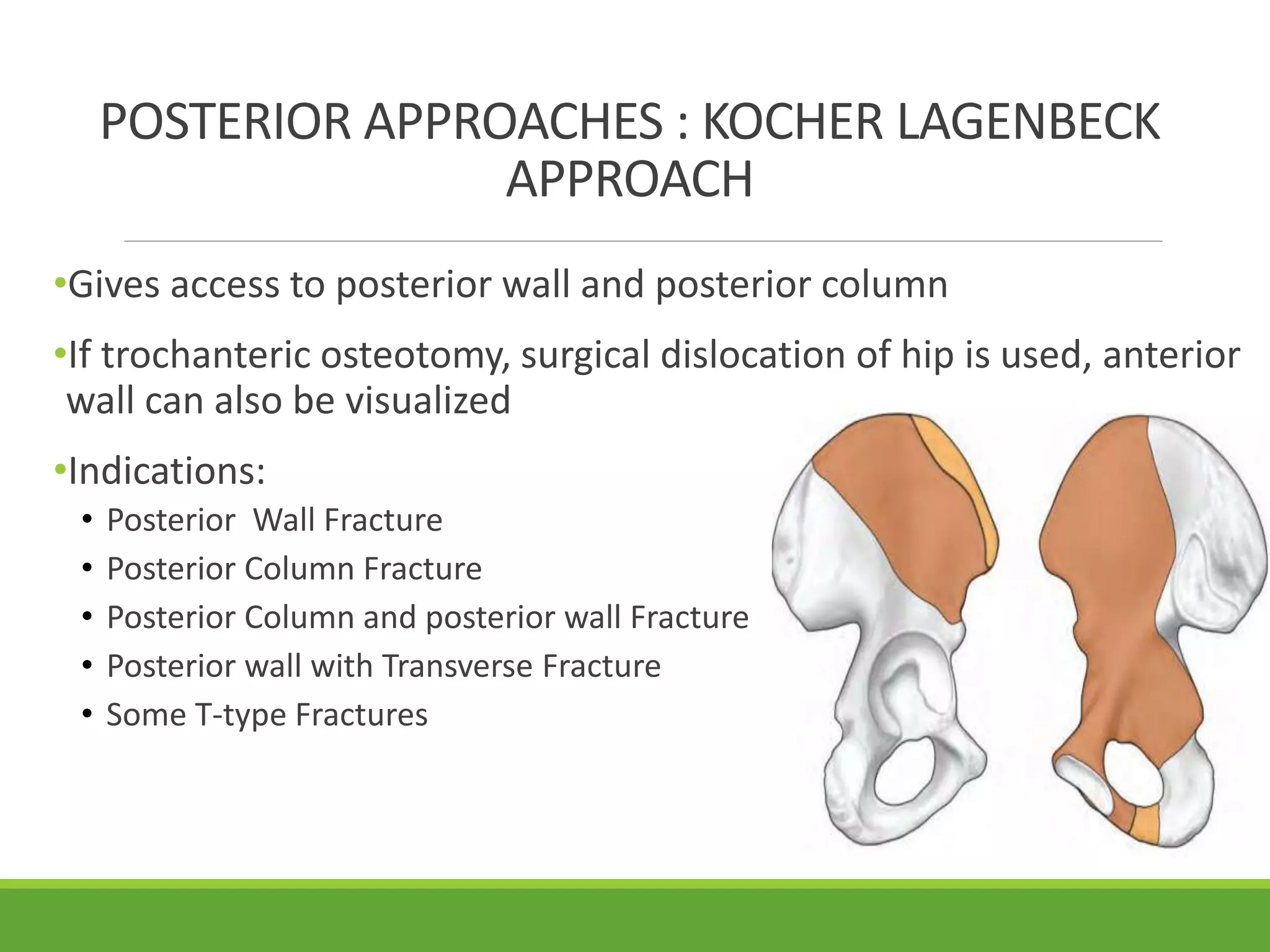 Surgical Approaches to Acetabulum and Pelvis | PPTX