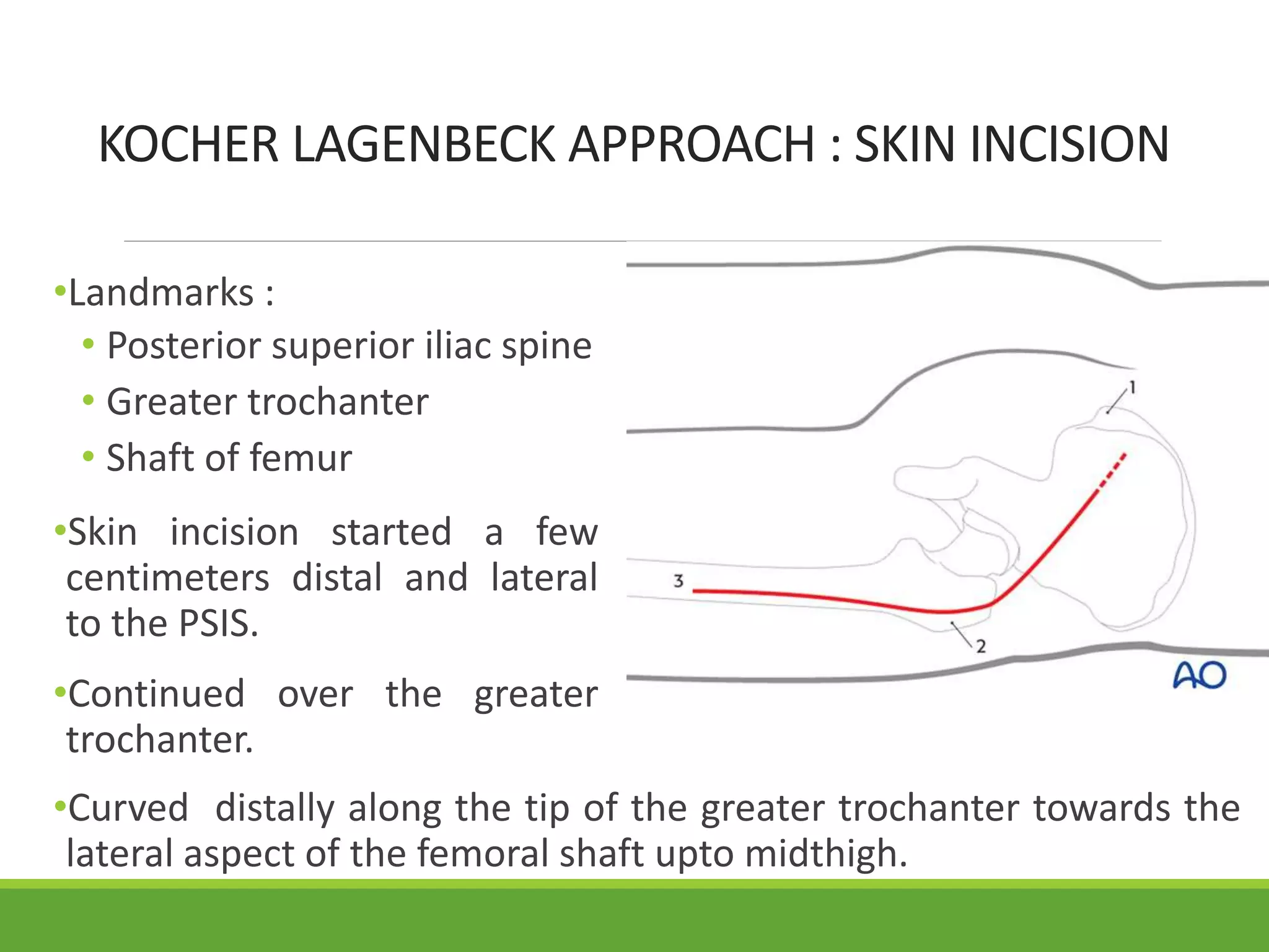 Surgical Approaches to Acetabulum and Pelvis | PPTX