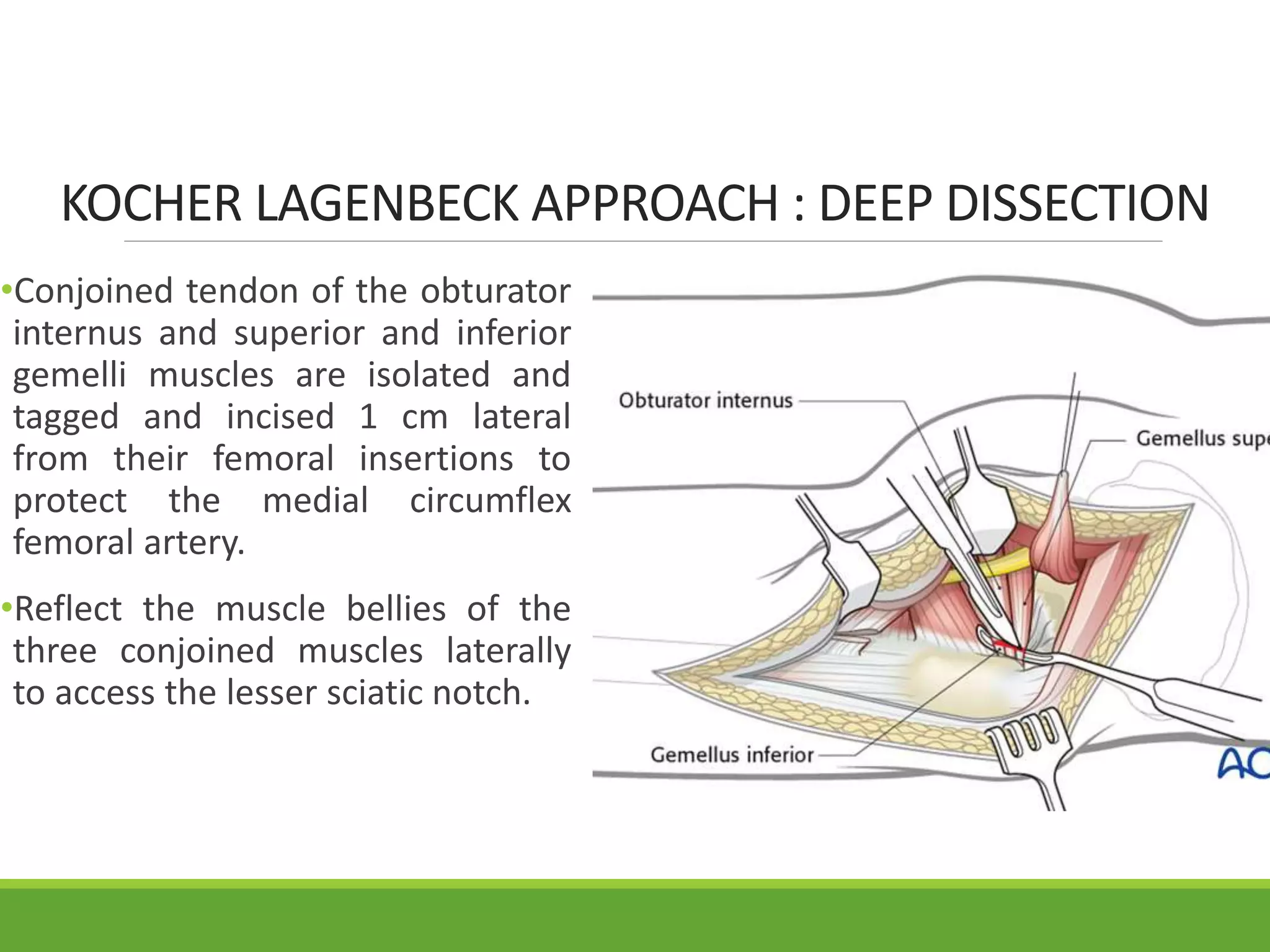Surgical Approaches to Acetabulum and Pelvis | PPTX