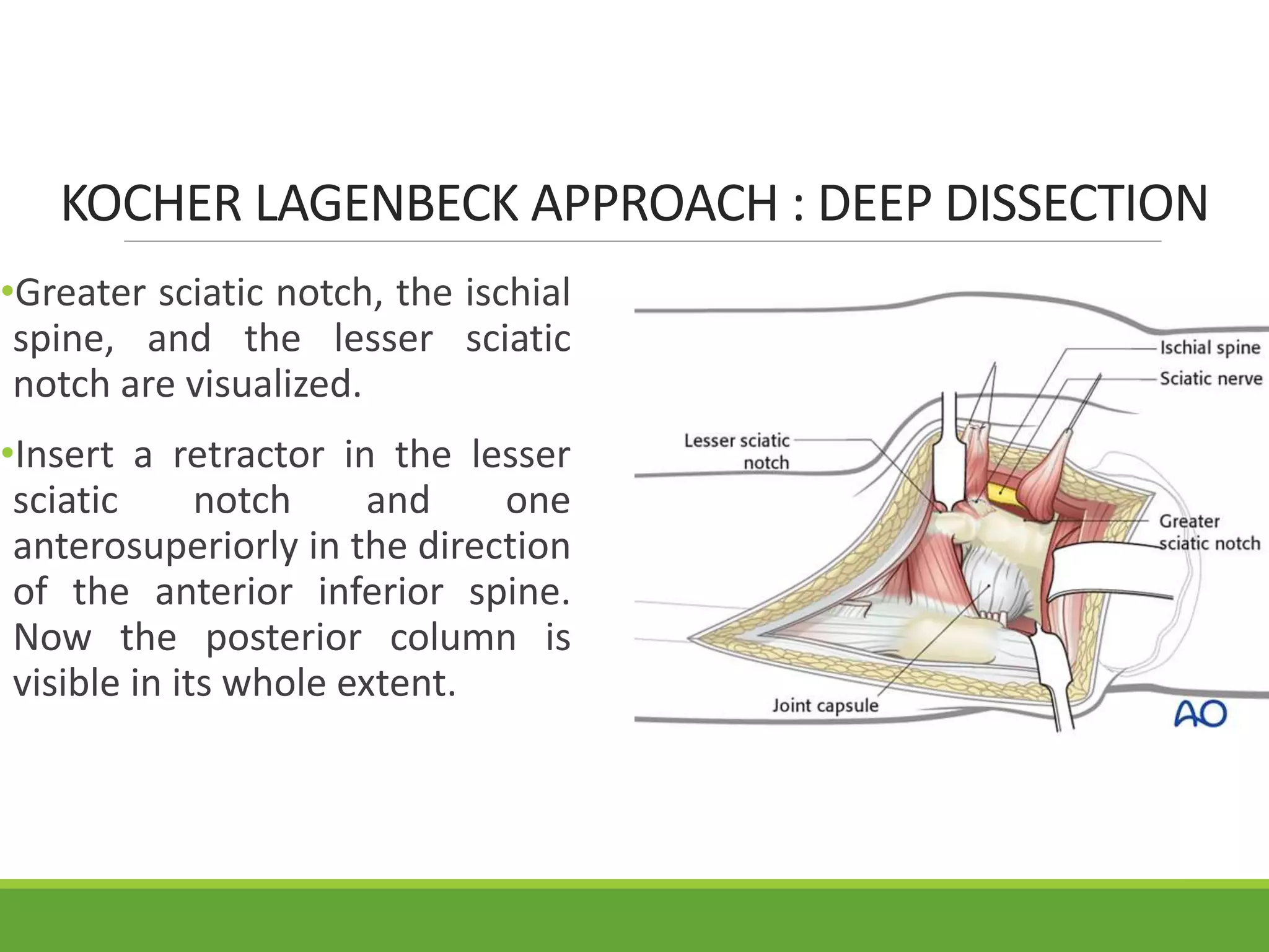 Surgical Approaches to Acetabulum and Pelvis | PPTX