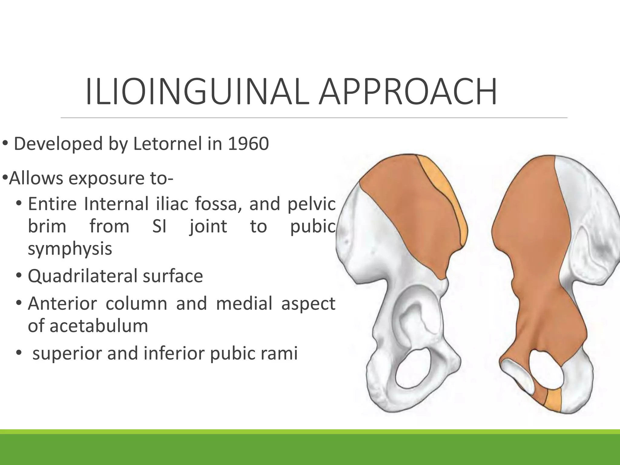 Surgical Approaches to Acetabulum and Pelvis | PPTX