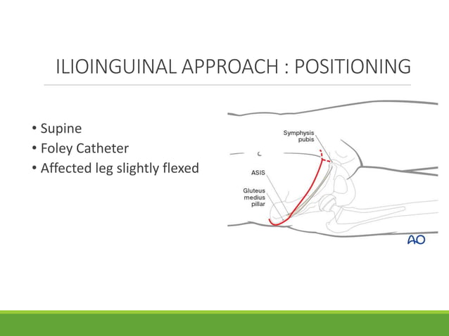 Surgical Approaches to Acetabulum and Pelvis | PPTX