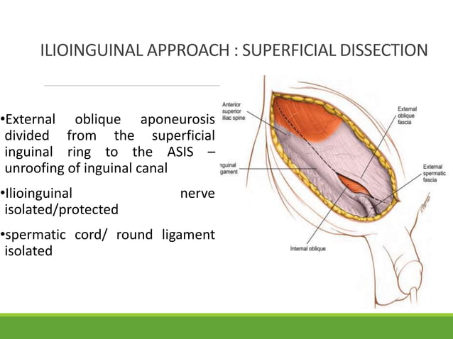 Surgical Approaches to Acetabulum and Pelvis | PPTX